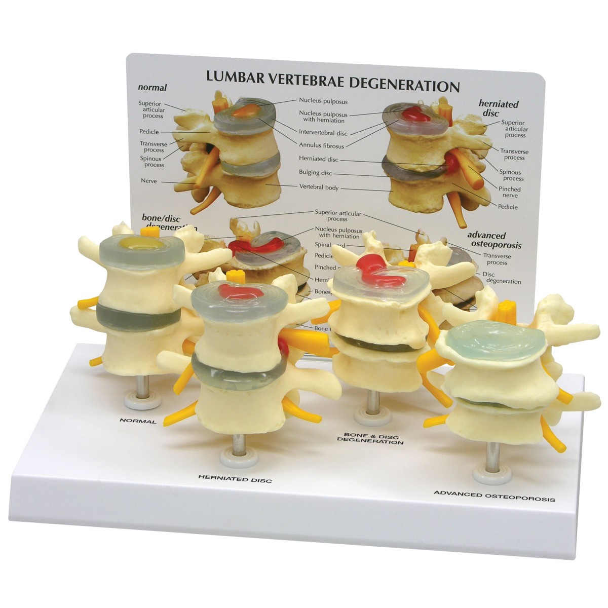 4-Stage Vertebrae Degeneration Model - Vertebrae - Skeletal System ...